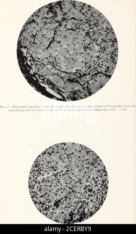 Mt Sinai Hospital Reports . Fig 6 Papillary carcinoma, showing atypical ...