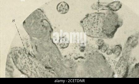 . American journal of obstetrics and gynecology. Fig. 2.—Telangiectatic ...
