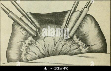 . Operative surgery, for students and practitioners . Lembert suturesof ...