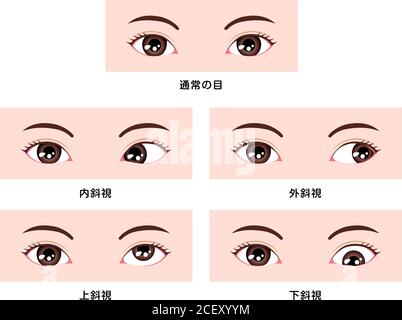 Types of strabismus vector illustration Stock Vector Image & Art - Alamy