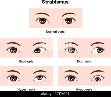 Strabismus types. Hypotropia, hypertropia, exotropia, esotropia. Human ...