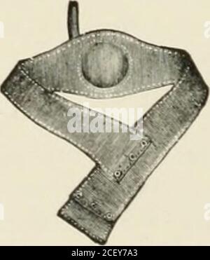 An umbilical hernia in a child on the stomach through a magnifying ...