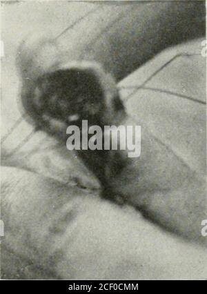 . Annals of surgery. Same as Fig. 7 (two months after operation).Dorsal ...