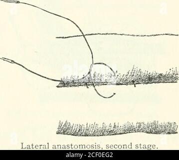 Annals of surgery . Fig. 4.—Suture of complete transverse woutul ; A ...