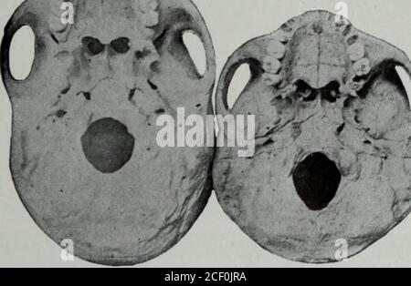 . The Dental cosmos. Normal occlusion of molars: transverse section ...