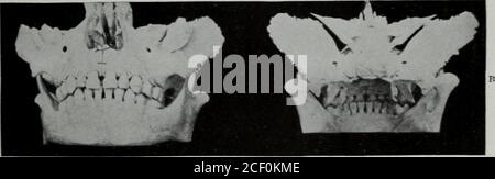. The Dental cosmos. Normal occlusion of molars: transverse section ...