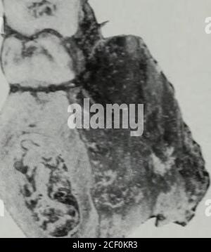 . The Dental cosmos. Normal occlusion of molars: transverse section ...