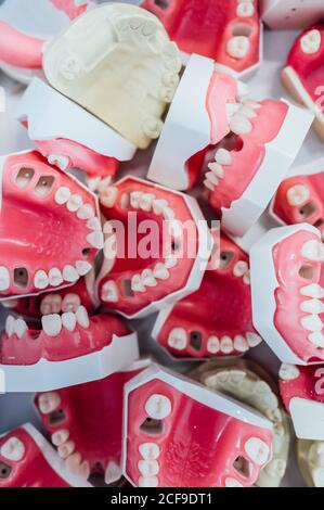 Orthodontic dental cast plaster models showing over bite Stock Photo ...