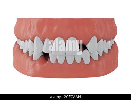 3d render of upper jaw with teeth and dental premolar implant over ...