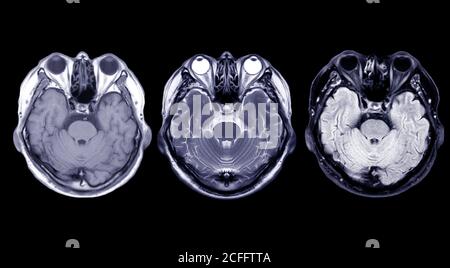 MRI brain scan axial view for detect Brain diseases sush as stroke disease, Brain tumors and ...