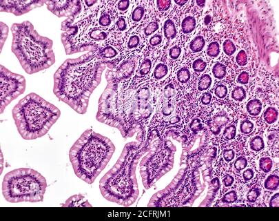 Intestinal cancer cells, brightfield photomicrograph Stock Photo - Alamy