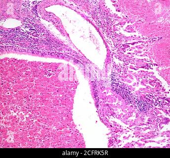 Lung cancer cells, brightfield photomicrograph Stock Photo - Alamy