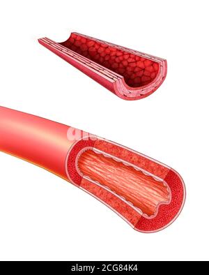 Illustration of a cross section of a blood vessel. At top is a dilated ...