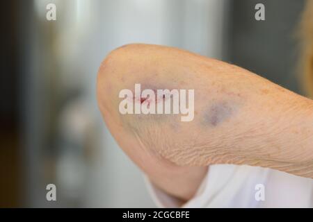 Elderly 80-year old woman with a broken or fractured elbow joint ...
