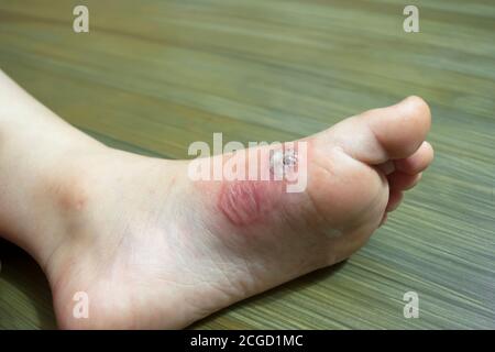 Skin ulcer close up on the top of foot from being in a cast. Pressure ...