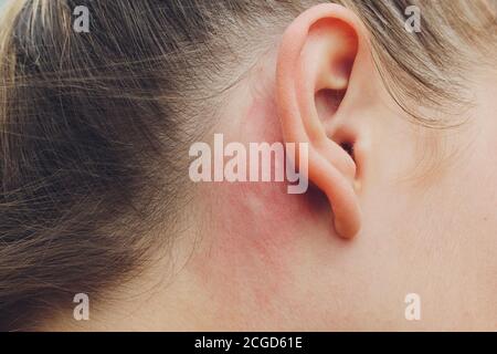 wound behind ear Stock Photo - Alamy