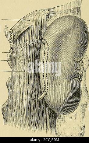 . On the origin and progress of renal surgery, with special reference ...