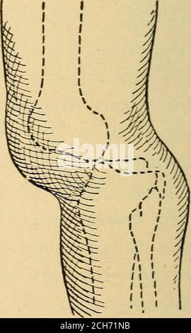 Reduction of a dislocation of the leg Stock Photo - Alamy