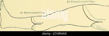. Operative surgery. ^ The Oval or Racket Method.—The oval or ...