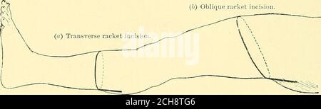. Text-book of operative surgery . incision is made, the upper end of ...