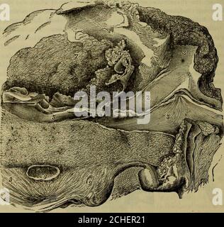 . Gaillard's medical journal . Fig. i. Fallopian Tubes, from a Case of ...