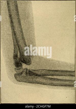 . Atlas and epitome of traumatic . above the lower articular-urface. at ...