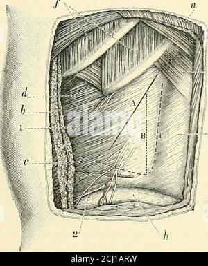 . Manual of operative surgery. e the crest of the ilium (Fig. 773 ...