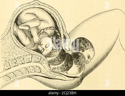 . The science and art of midwifery . -occipito-bregmatic. The OCCipito ...