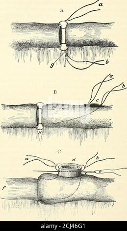 . Manual of operative surgery. into the lumen of the gut by apurse ...