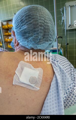 a patient has a large abscess on his back Stock Photo - Alamy