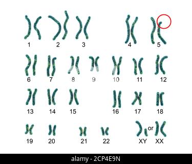 Karyotype of a patient with cri du chat syndrome (also known as Cat cry ...