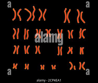 Karyotype of a patient with cri du chat syndrome (also known as Cat cry ...