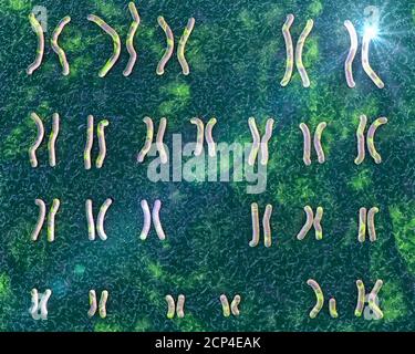 Karyotype of a patient with cri du chat syndrome (also known as Cat cry ...