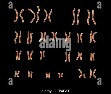 Karyotype of Prader-Willi syndrome, computer illustration. This is a ...