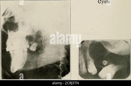 . Interpretation of dental & maxillary roentgenograms . Cysts. A. B ...