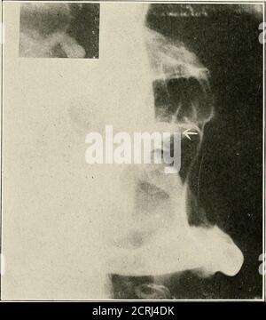 . Interpretation of dental & maxillary roentgenograms . Cysts. A. B ...