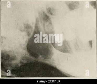 . Interpretation of dental & maxillary roentgenograms . Cysts. A. B ...