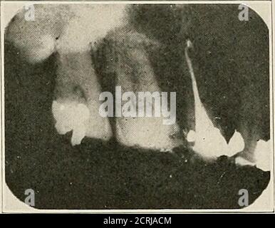 . Interpretation of dental and maxillary roentgenograms . c. Fig. 212 ...