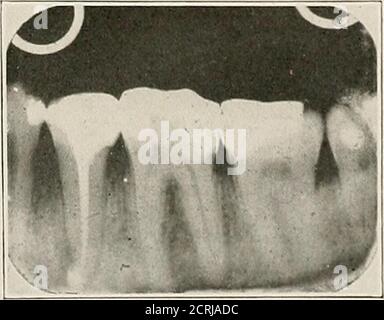 tooth rootcanal treatment Stock Photo - Alamy