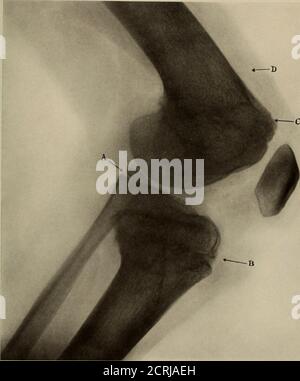 . Living anatomy and pathology; . PLATE 161. CELLULITIS OF TISSUES OF ...