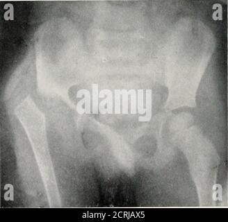 TUBERCULOSIS IN THE BONES, X-RAY Stock Photo - Alamy