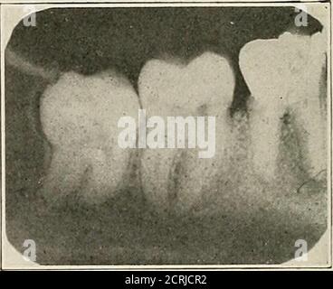 Lower molar periapical x-ray with root canal treatment with coronal ...