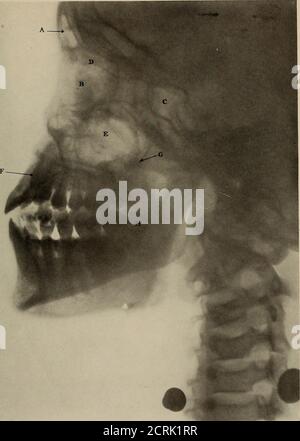 Anatomy of maxillary lateral incisor tooth and gum (cross section ...