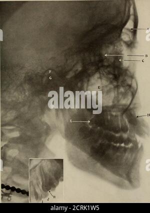 Anatomy of maxillary lateral incisor tooth and gum (cross section ...