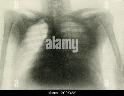 Pneumonia in a right lung (acute respiratory infection), revealed by ...