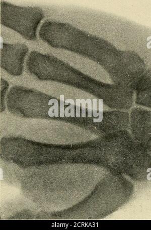 . Röntgen ray diagnosis and therapy . the os trigonum tarsi asan ...