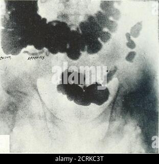 . Archives of physical medicine and rehabilitation . rig. 6 —Arrested ...