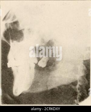 . Interpretation of dental & maxillary roentgenograms . Cysts. A. B ...