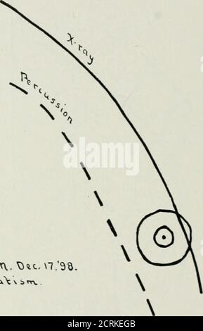 x-rays, pulmonary emphysema Stock Photo - Alamy