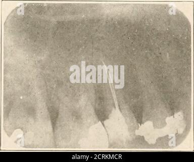 . Interpretation of dental and maxillary roentgenograms . c. Fig. 212 ...